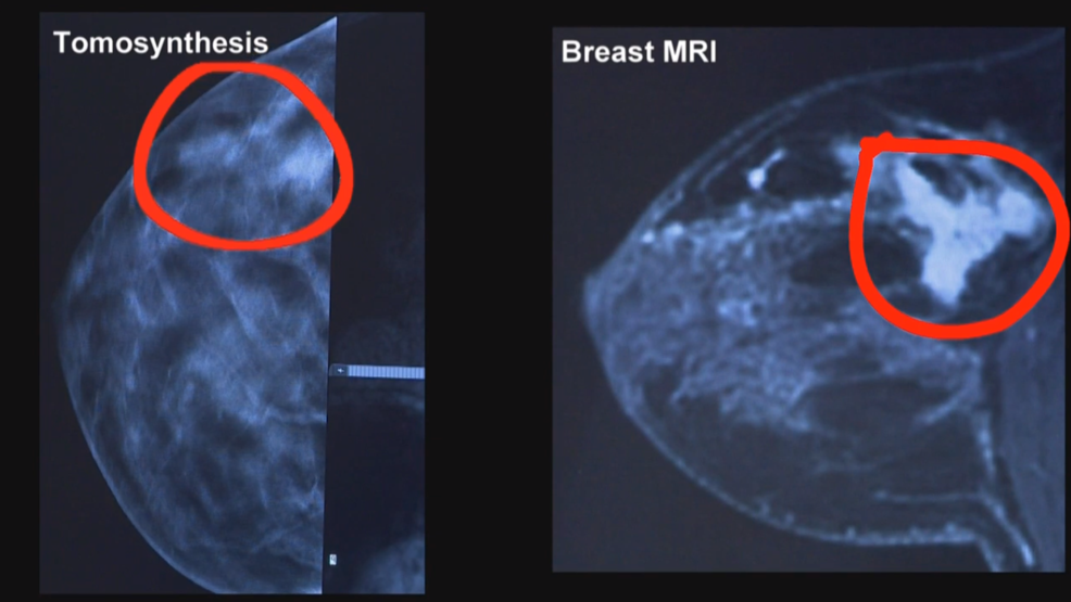 New Study Hopes To Effectively Detect Breast Cancer Amidst More Dense